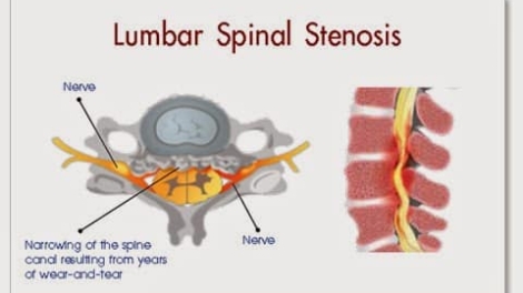 Spinal Stenosis - Corrective Chiropractic by Dr. Bret Wickstrom